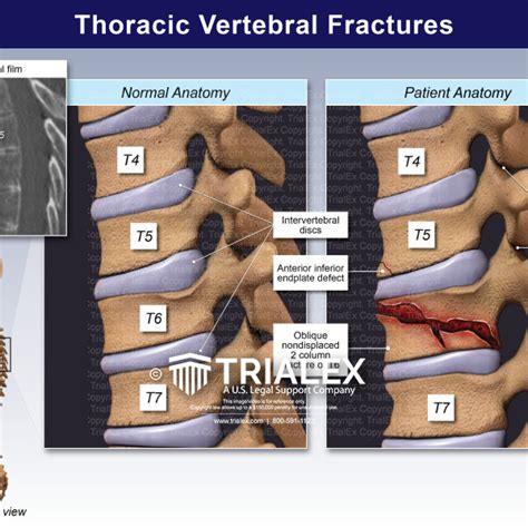 Thoracic Vertebral Fractures Trialexhibits Inc