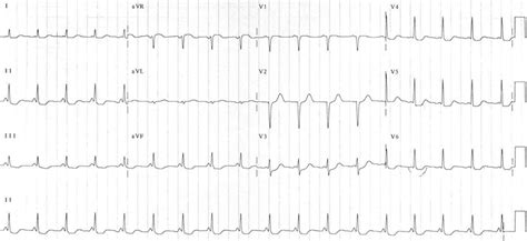 Lown Ganong Levine Lgl Syndrome Ecg