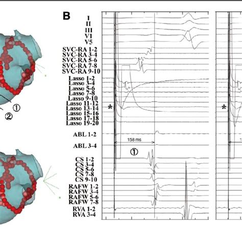Three Dimensional Electroanatomic Map Carto Image And Intracardiac