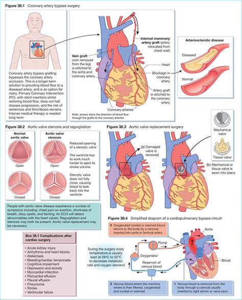Principles Of Cardiac Surgery Nurse Key
