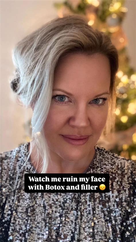 Two Powerhouse Treatments But They Work Very Differently 💉 Radiesse