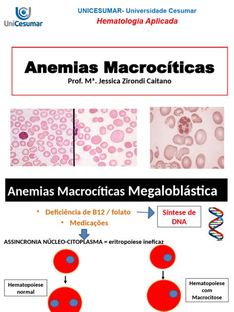 Aula 5 Anemias Macrocíticas Pdf Anemia Vitamina B12