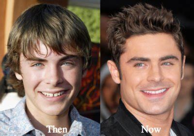 Zac Efron Plastic Surgery Nose Job Before And After Photos