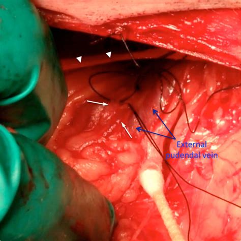 Intraoperative Imaging Of The Mammary Lymphatic Vessels The Skin Download Scientific Diagram