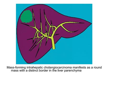 Diagnostic Imaging Of Cholangiocarcinoma Ppt Digestive Disorders