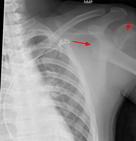 Growth Plate Fracture Causes Types Symptomstreatment
