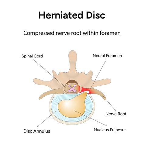 Premium Vector Herniated Disc Compressed Nerve Root Within Foramen In