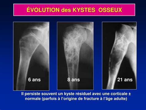 Ppt Kyste Osseux Kyste Solitaire Powerpoint Presentation Free