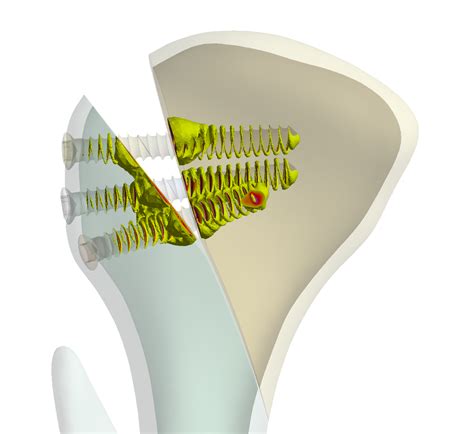The Science Behind A Healing Jaw Finite Element Analysis Of Mandibular