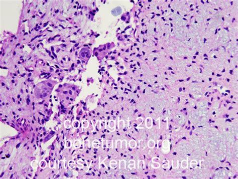A 58 Year Old Man With A Right Proximal Tibia Lesion