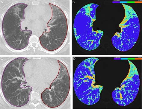 Quantitative Chest Computed Tomography For Progression Of In Journal Of Thoracic Imaging