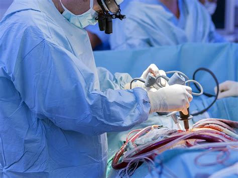 Quintuple Bypass Surgery Definition