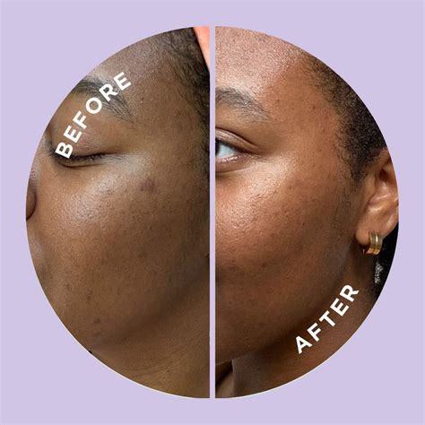 Hyperfade By Zitsticka Microdart Patch Fade Post Zit Dark Spots Buy Now With Express