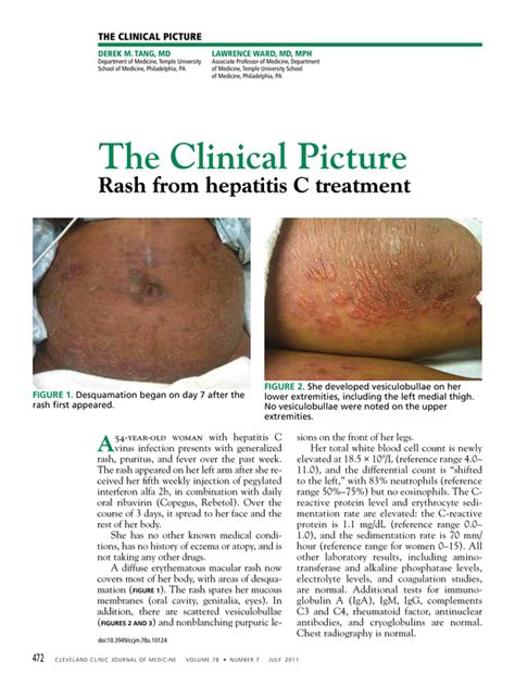 Hepatitis C Rash
