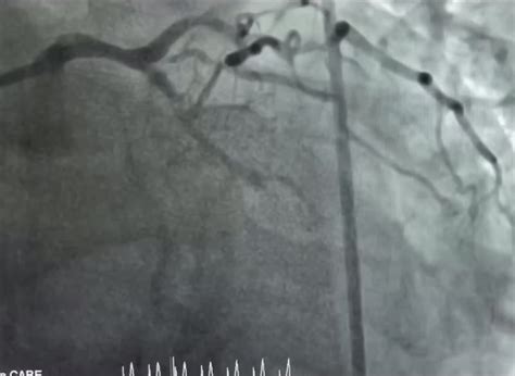 Laurian Blaga On Linkedin Male 71 Y Old With Lcx Chronic Total Occlusion I Tried Pilot 50 Pilot…