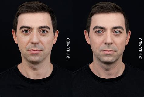 Nctf Boost 135ha Top Beauty