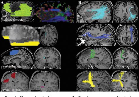 Figure 1 From Comparison Of Diffusion Tensor Imaging Tractography Of