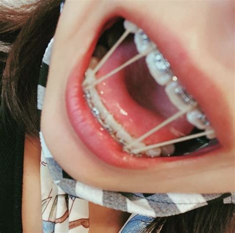 How To Put Rubber Bands On Braces Artofit