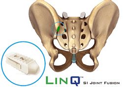 LinQ Procedure Offers New Hope To Patients With SI Joint Pain Ioannis M Skaribas MD DABA