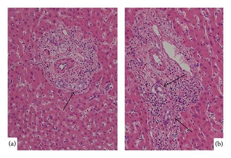 What Are The Precursor And Early Lesions Of Peripheral Intrahepatic Cholangiocarcinoma Pmc