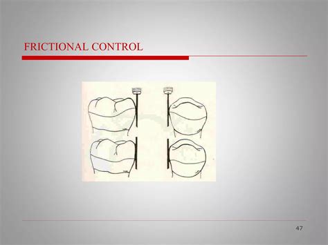 Designing For Kennedy Class I And Class Ii Ppt Oral Care Personal Care
