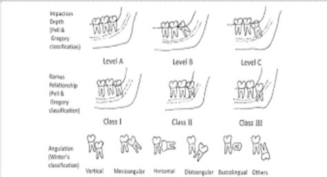 Radiographic Evaluation Of Impacted Third Mandibular Molar According To