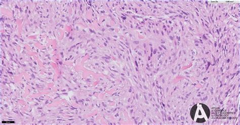 Bone Conventional Osteosarcoma