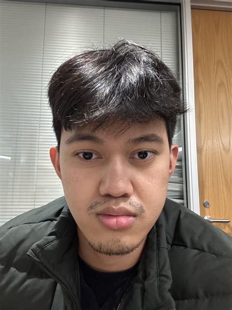 day 0 to day 3 post op i had djs to correct my class 3 underbite with dr williams here in