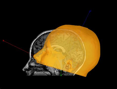 Errors In Coregistration Between Mri And Fem Models Created By Simnibs