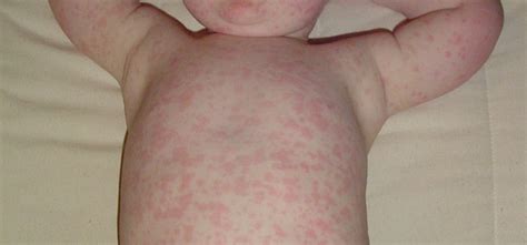 Lets Learn About Fifth Disease