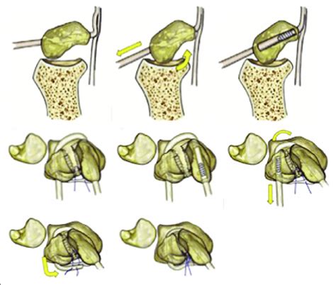 All Arthroscopic Scapholunate Ligament Reconstruction Using FCR Graft Download Scientific