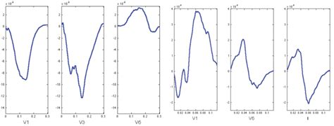 Simulated Qrs Morphology In Bbb Conditions A Lead V 1 V 2 And V 6