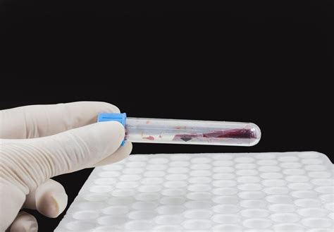 Girft Why The New Pathway For Diabetes Care Is In Place