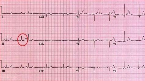 Cardiac Arrhthmia Pathophysiology Treatment Pptx