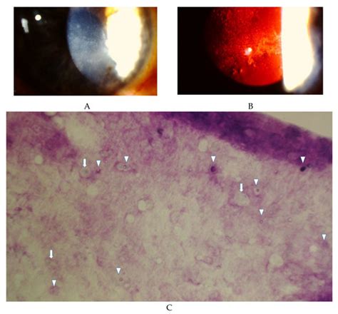 Acanthamoeba Keratitis Life Cycle