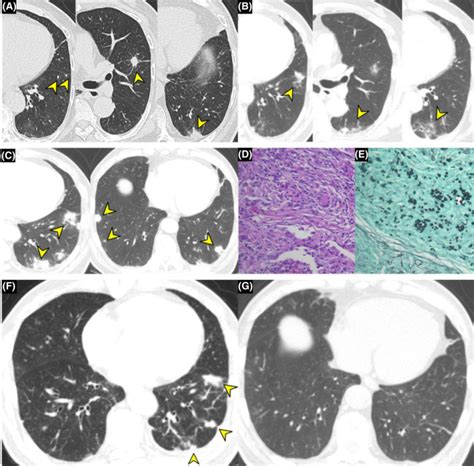 A Rare Occurrence Of Paragonimiasis Accompanied By Cryptococcal