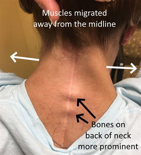 Discectomy Scar Neck