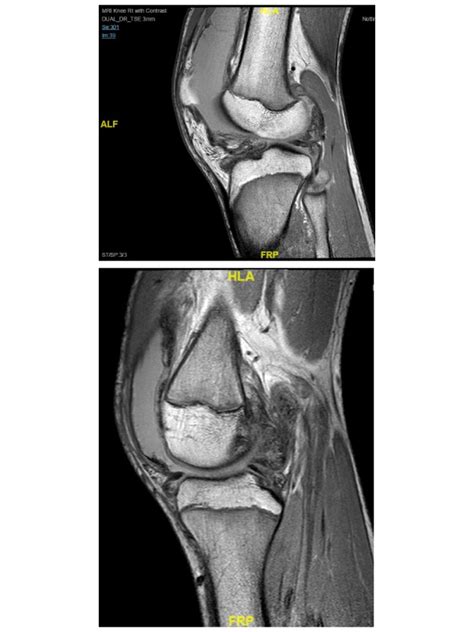 Knee Swelling In A Teenager Infection Inflammation Or Malignancy International Journal Of