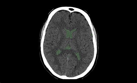 Rtstruct Segmentation Discrepancy Support 3d Slicer Community
