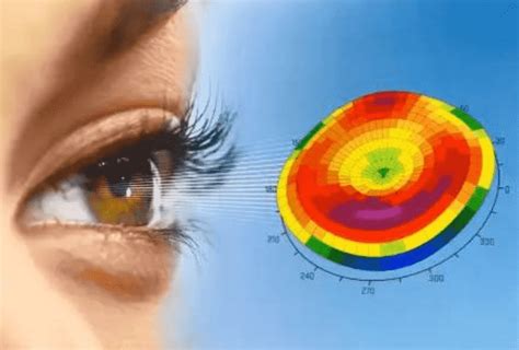 Contoura Vs Lasik A Comparative Analysis For Vision Correction
