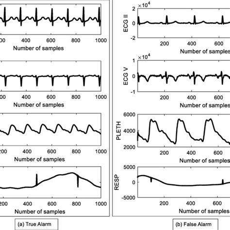 Input Signals Ecg Pleth Abp Obtained During Tachycardia Condition A Download Scientific