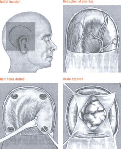 Craniotomy Nurse Key