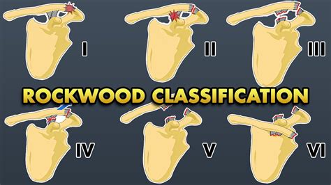 Rockwood Classification Of Acromioclavicular Joint Injury Modified