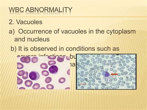Wbc Abnormality Ppt