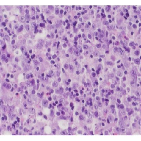 A Plasmablastic Lymphoma With Immunoblastic Morphology Involving