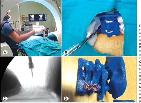 Figure 1 From Augmented Reality Supported Cervical Transpedicular Fixation On 3d Printed