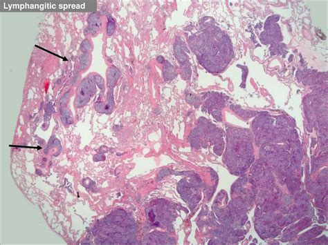 Ppt M 56 A Round Nodular Density In Rll Powerpoint Presentation Free Download Id 4967953