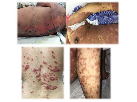 Chủ quan không đến bệnh viện sớm người bệnh dị ứng thuốc với hội chứng