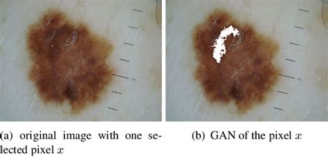 Figure 2 From Automatic Classification Of Skin Lesions Using