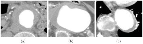 Figure 2 From Three Dimensional Thrombus Segmentation In Abdominal Aortic Aneurysms Using Graph